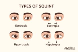 What is Squint Eyes? Causes, Treatment & Symptoms - Noble Eye Care