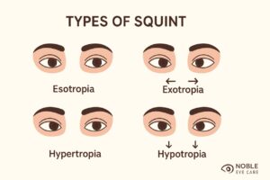 What is Squint Eyes? Causes, Treatment & Symptoms - Noble Eye Care