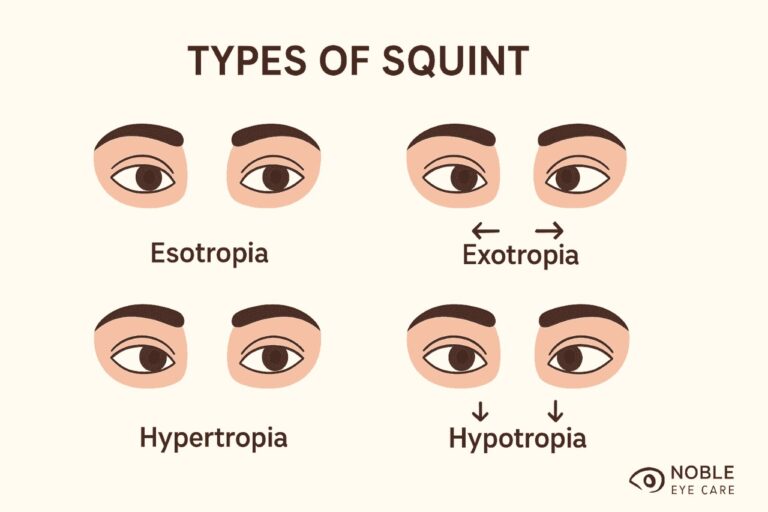 What is Squint Eyes? Causes, Treatment & Symptoms - Noble Eye Care